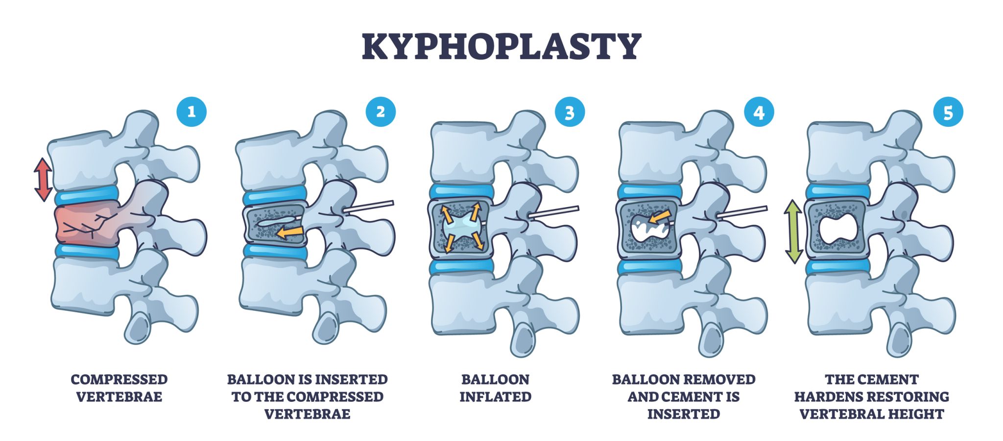 Kyphoplasty vs. Vertebroplasty: What Is the Difference?